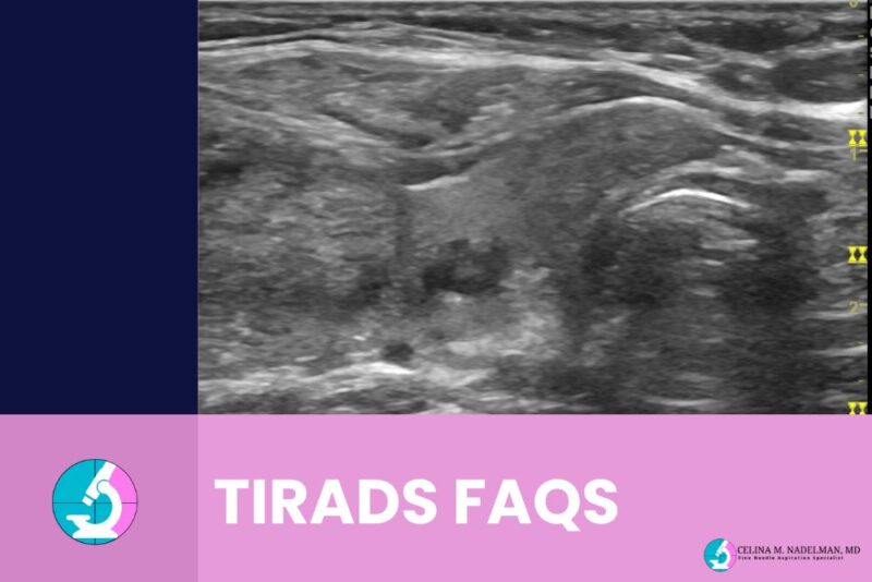 Understanding TIRADS & Thyroid Nodule Management Dr Nadelman