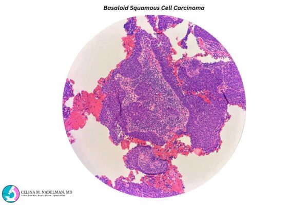 Understanding Hpv Related Throat Cancer In Men Dr Nadelman