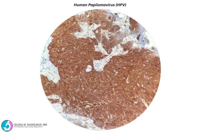 Understanding HPV-Related Throat Cancer in Men | Dr Nadelman